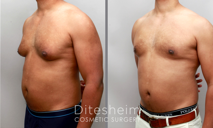Gynecomastia Before And After Bodybuilder