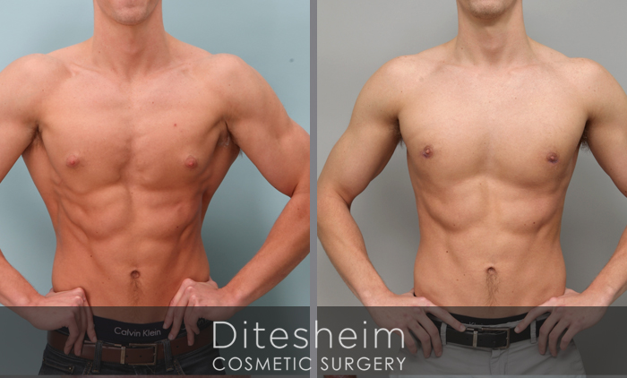 Gynecomastia Before And After Bodybuilder